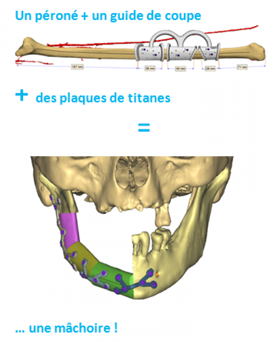 Innovation : la reconstruction d’une mâchoire grâce à la modélisation ...